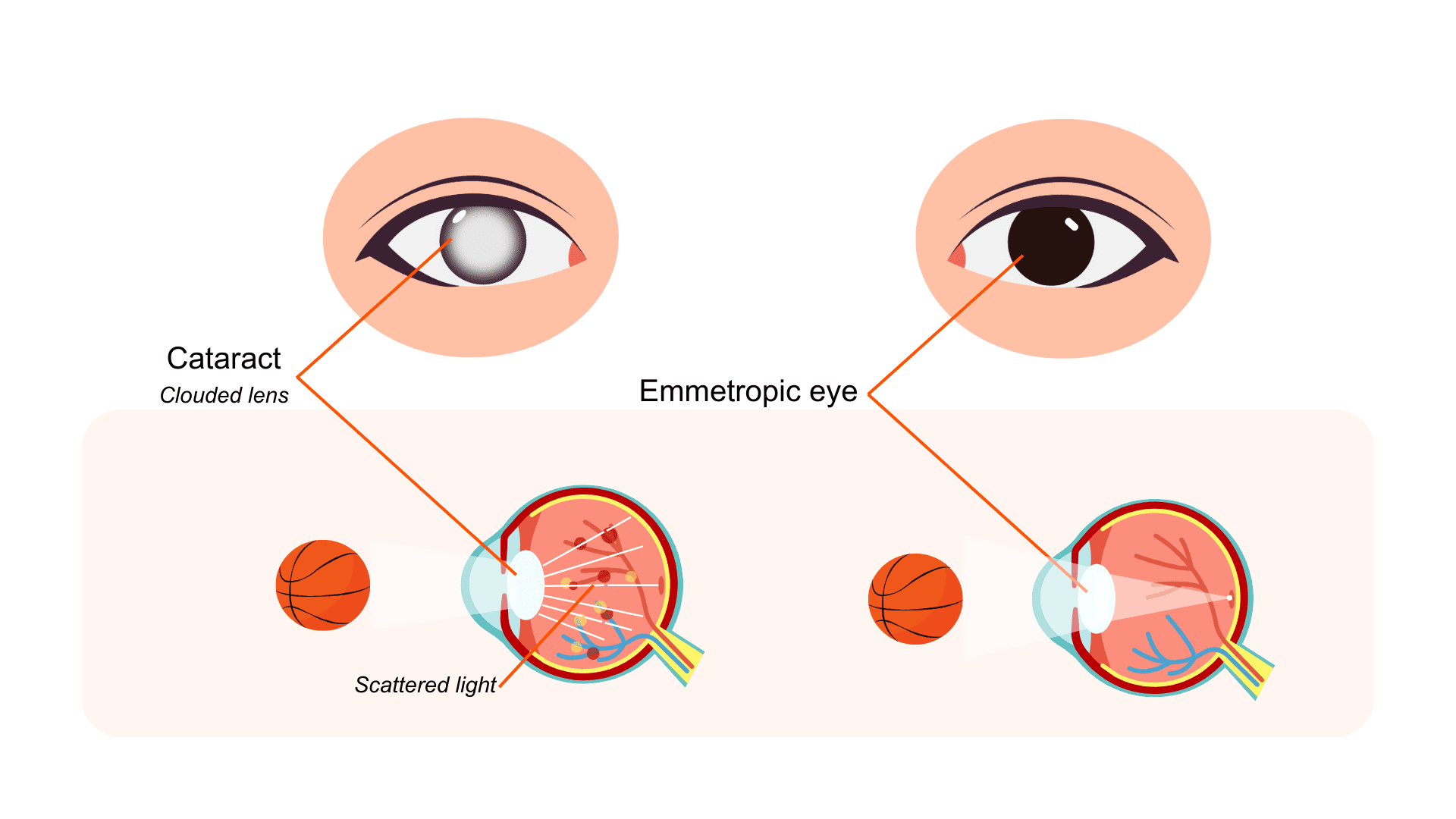 Femtosecond laser in ophthalmology - Amplitude